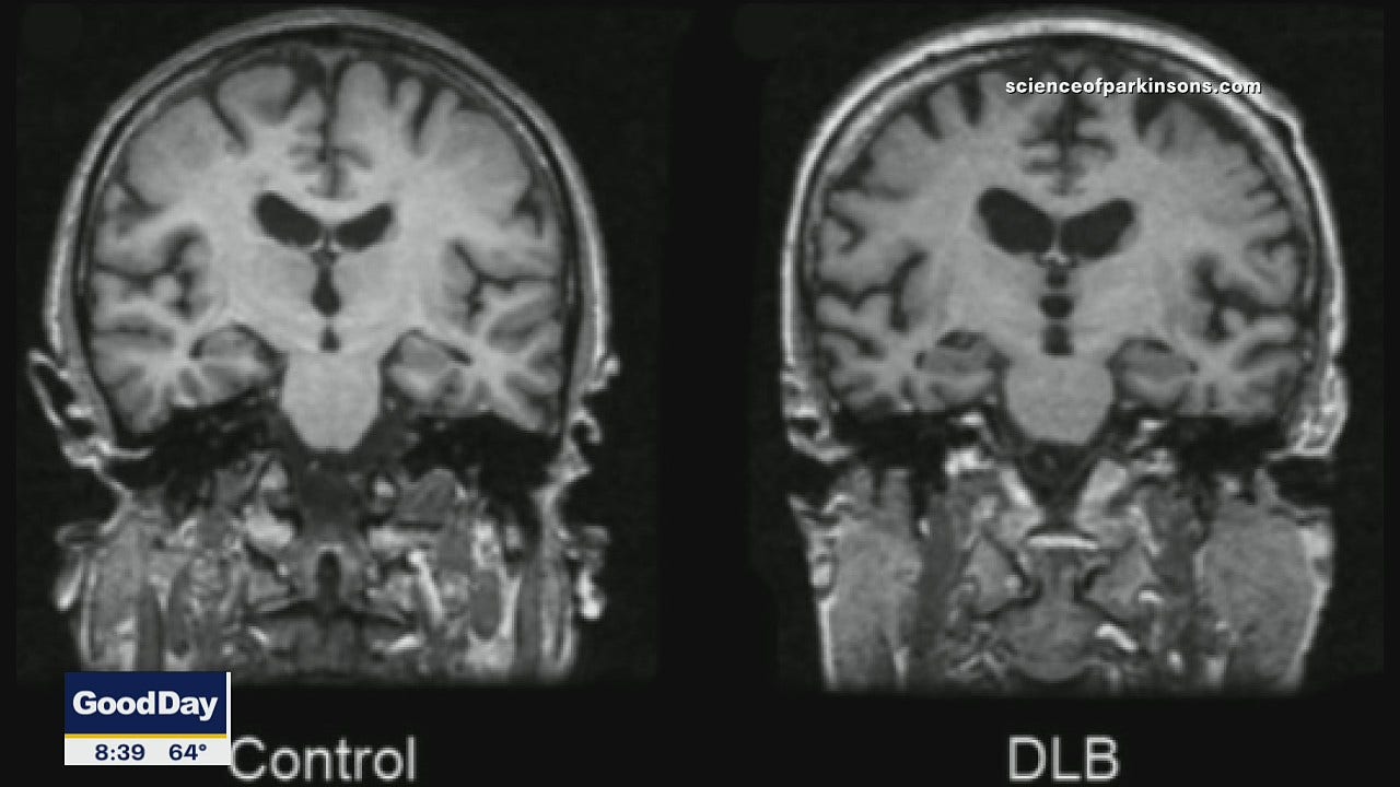 Facts about Lewy Body Disease | FOX 4 Dallas-Fort Worth