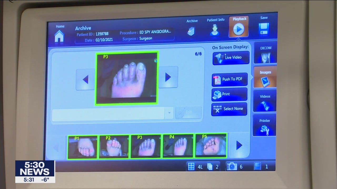 New device allows for faster treatment of frostbite patients | FOX 9 ...