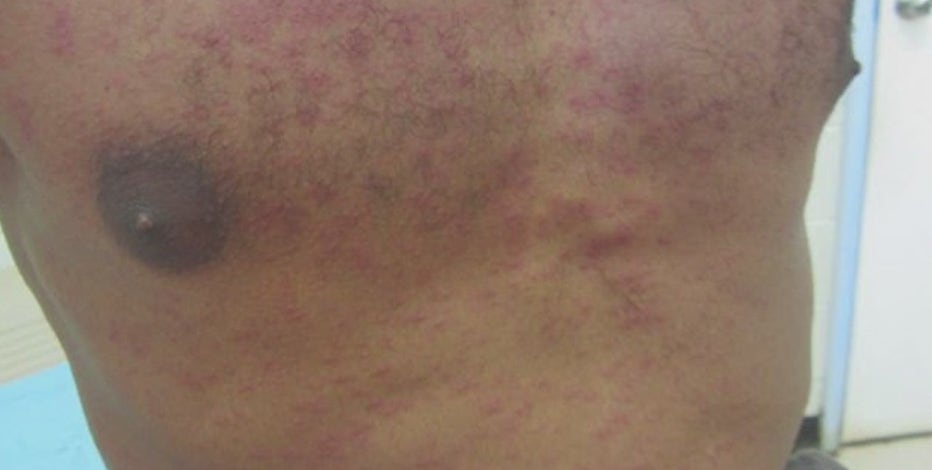 Measles cases in Chicago rise to five, prompting CDC assistance and ...