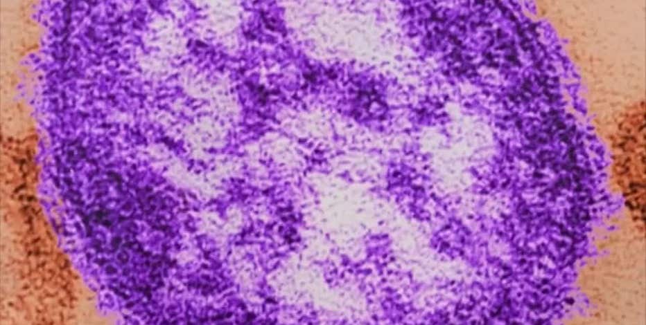 Measles case in Lake County, Illinois; part of Chicago outbreak | FOX6 ...
