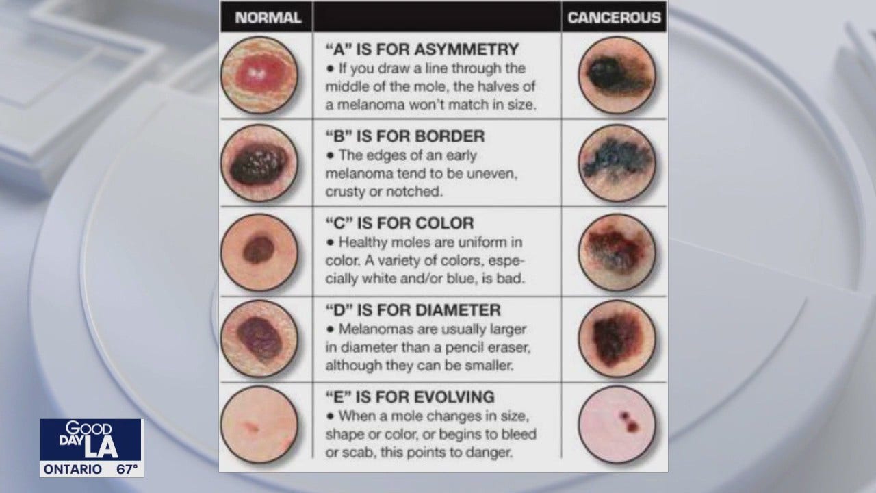 Skin cancer prevention: Mole checks | FOX 11 Los Angeles