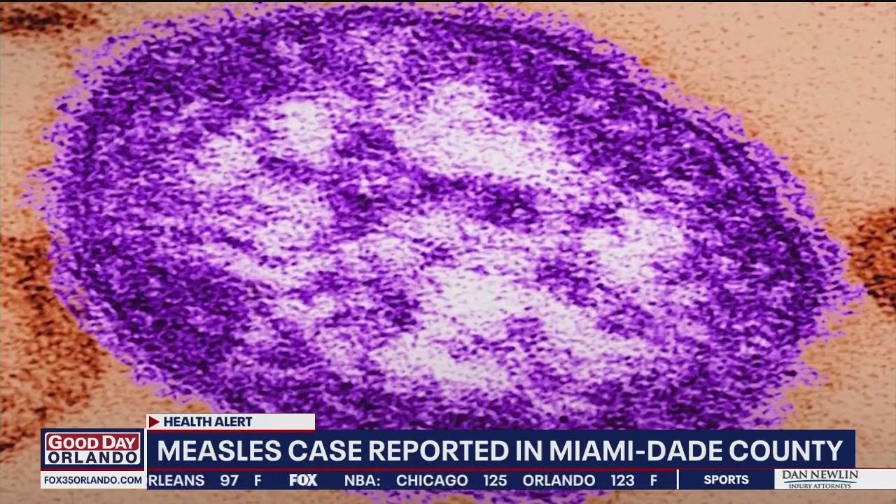 Measles case reported in Miami-Dade, Florida | FOX 35 Orlando