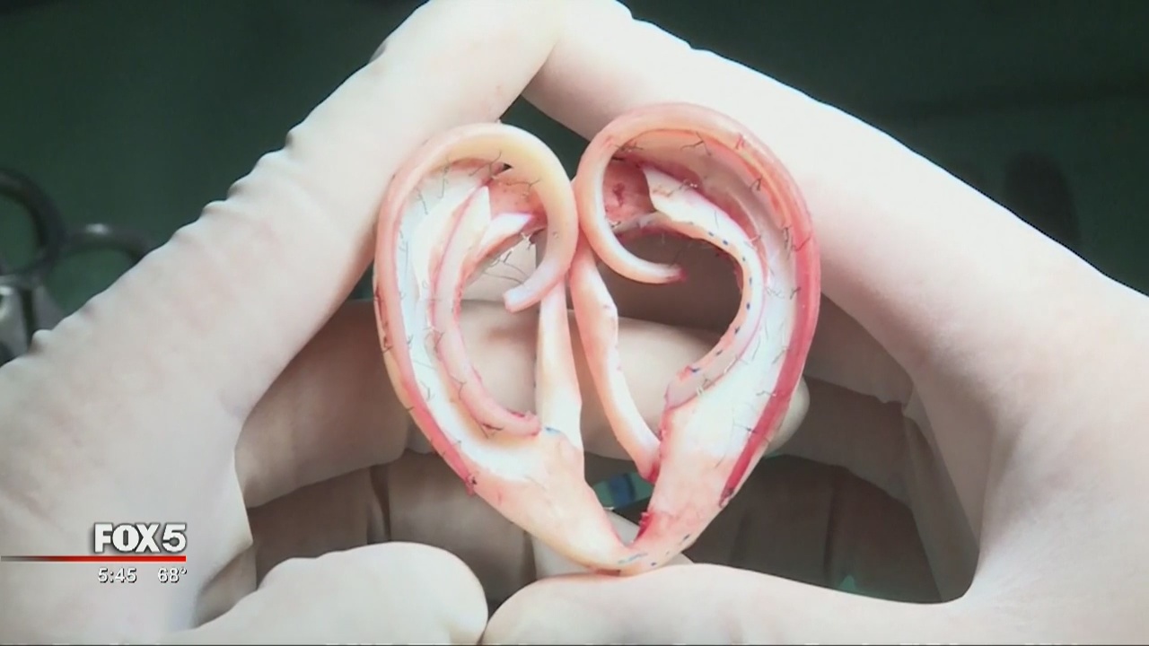 Ear grown on man's arm | FOX 5 Atlanta