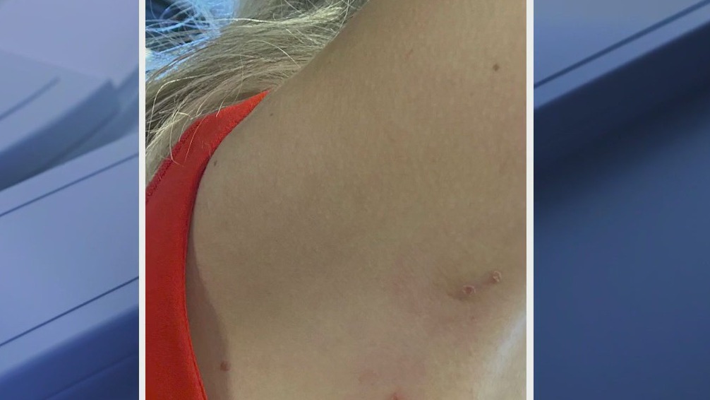Have you been experiencing mysterious bug bites? These mites could be ...
