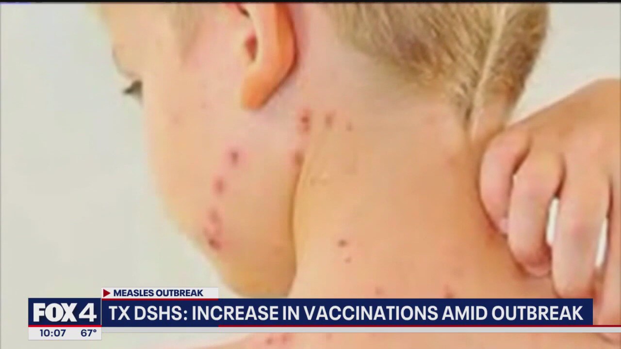 More measles cases detected in West Texas | FOX 4 Dallas-Fort Worth
