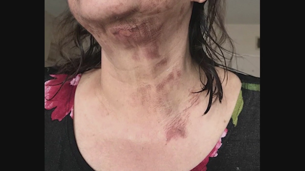 Woman speaks out about the NutriBullet giving her second-degree burns ...