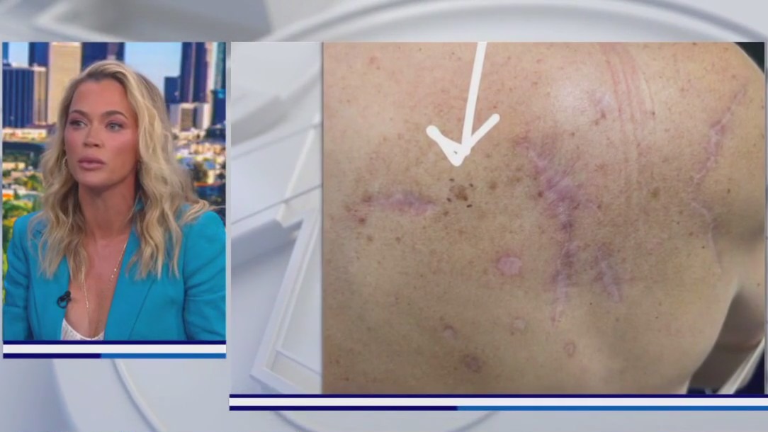 Real Housewives star shares personal battle with skin cancer | FOX 11 ...