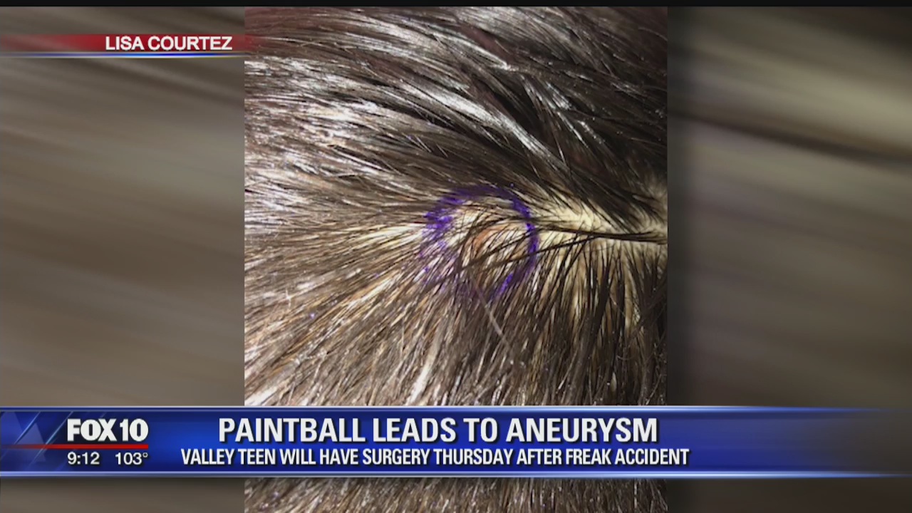 Valley boy requires surgery after freak paintball accident | FOX 10 Phoenix