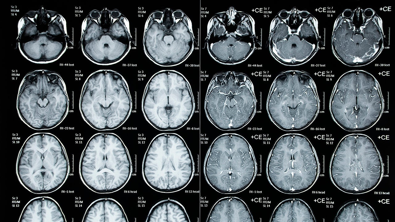 Cluster of brain infections left children ‘incredibly sick’: CDC ...