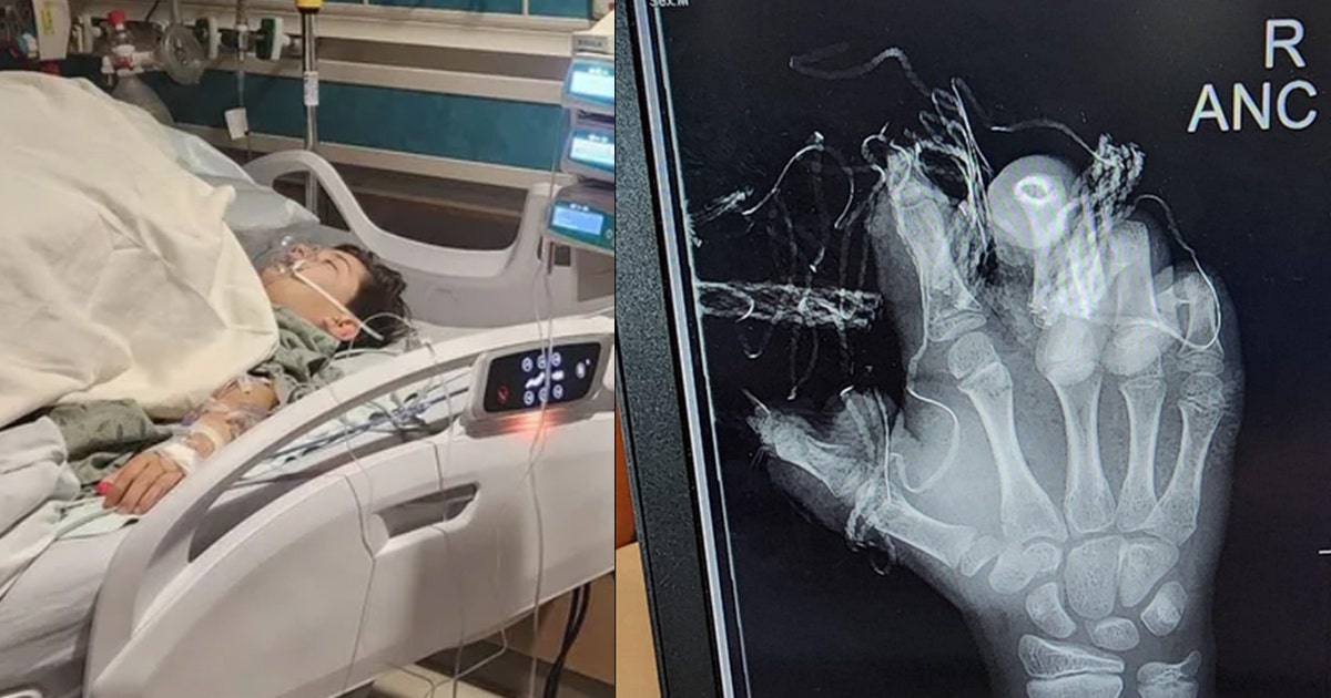‘I panicked’: Firework blows up in young Arizona boy’s hand | FOX 10 ...