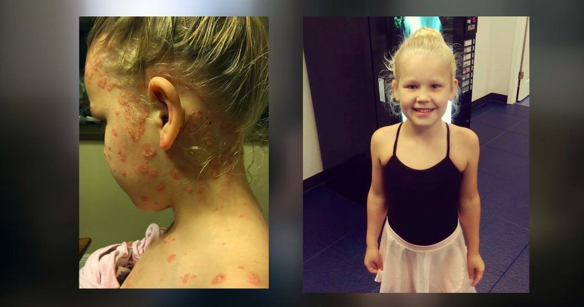 Psoriasis can be tough to treat in kids | FOX 13 Tampa Bay