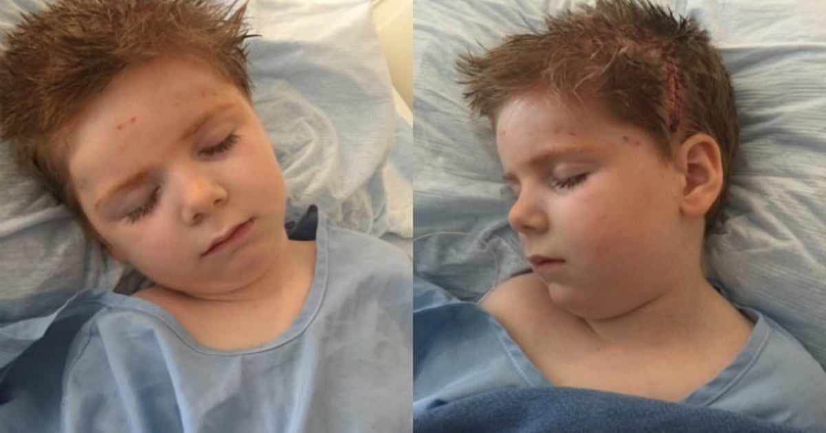 Tripp Halstead undergoes successful skull surgery | FOX 13 Tampa Bay