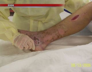 timber rattlesnake bite effects