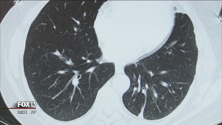 CT scan shows lung cancer undetectable by x-ray | FOX 13 Tampa Bay