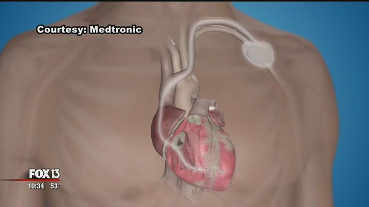 New way to install pacemakers mimics body's natural rhythm | FOX 13 Tampa Bay