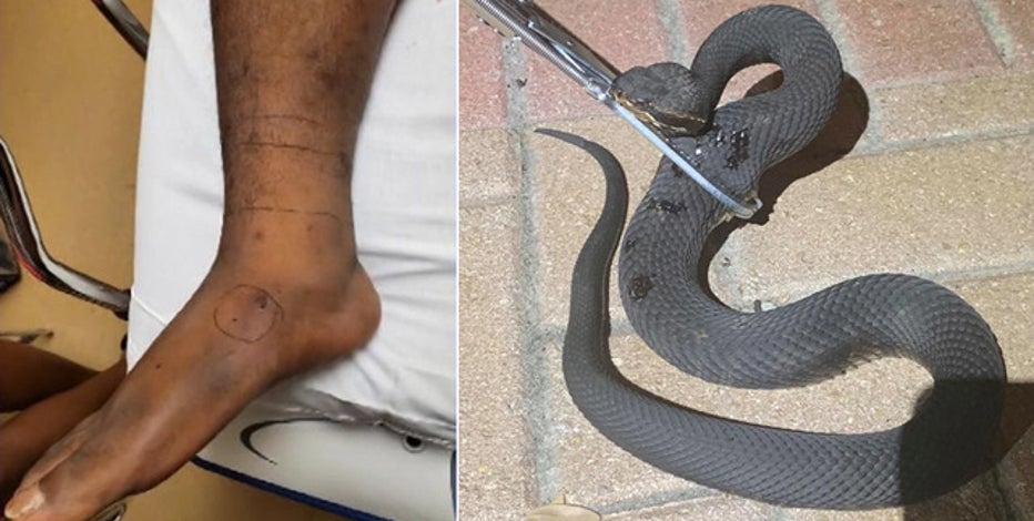 cottonmouth water moccasin bite