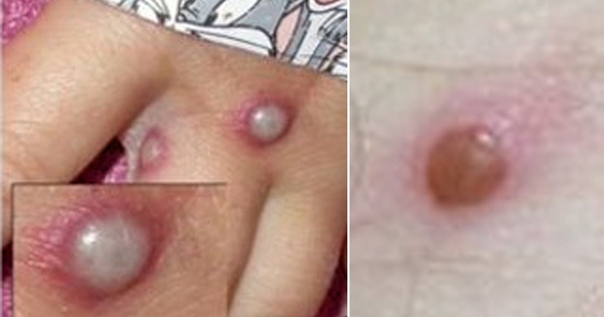 2nd presumptive case of monkeypox reported in Florida, officials say ...