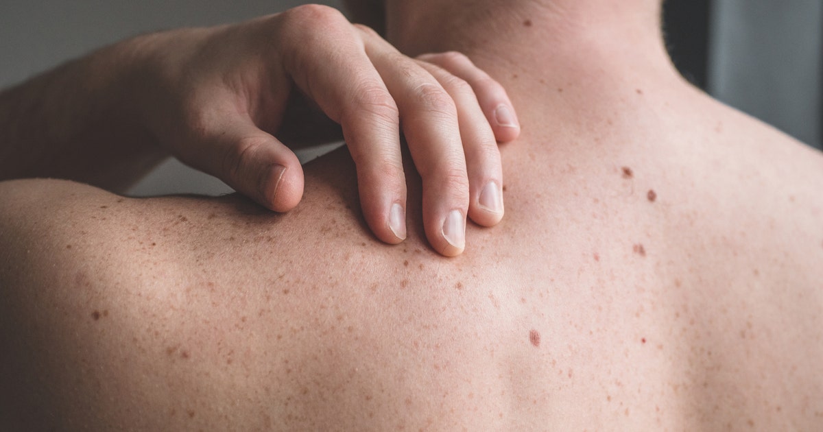 Merck, Moderna share positive progress of potential skin cancer vaccine ...