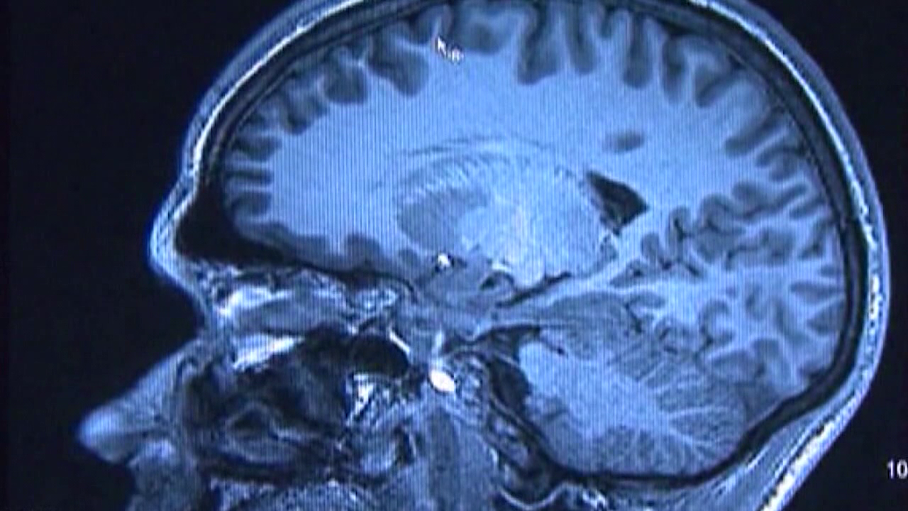Alzheimers Treatments Drugs Showing Some Promise Health Experts Say