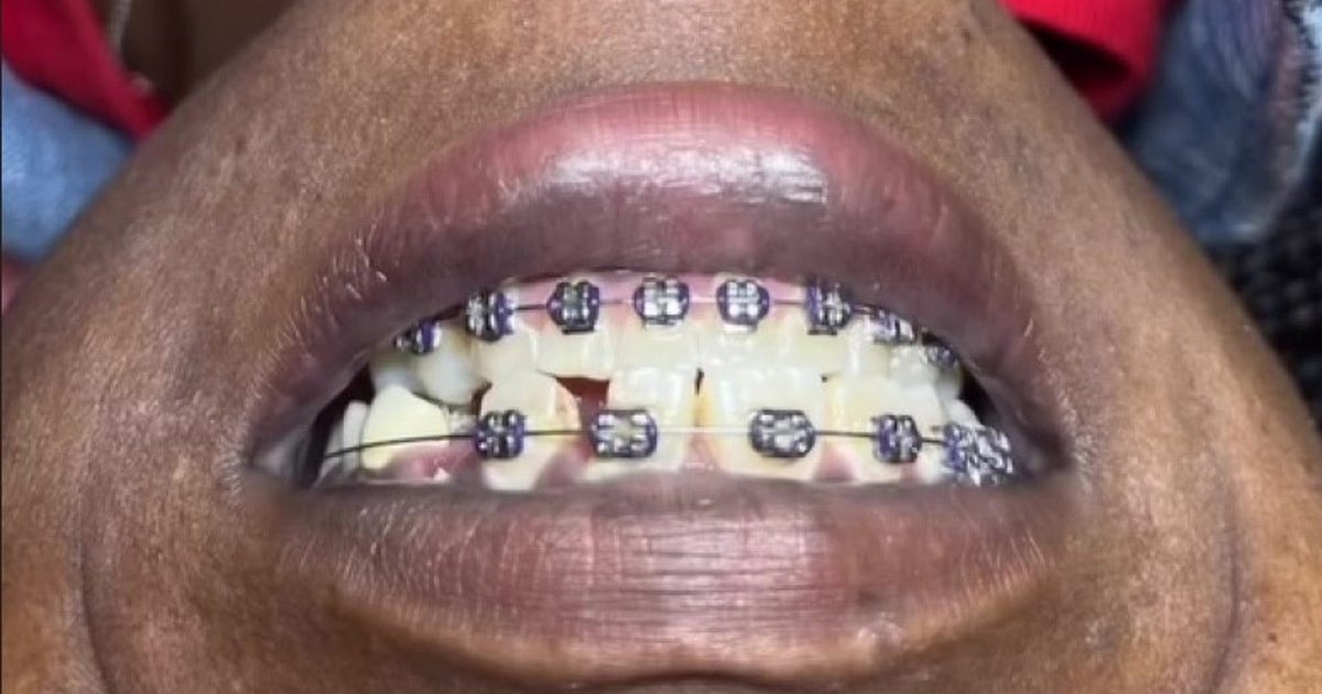 Dentists warn about dangers of illegal ‘veneer tech’ trend | FOX 13 ...
