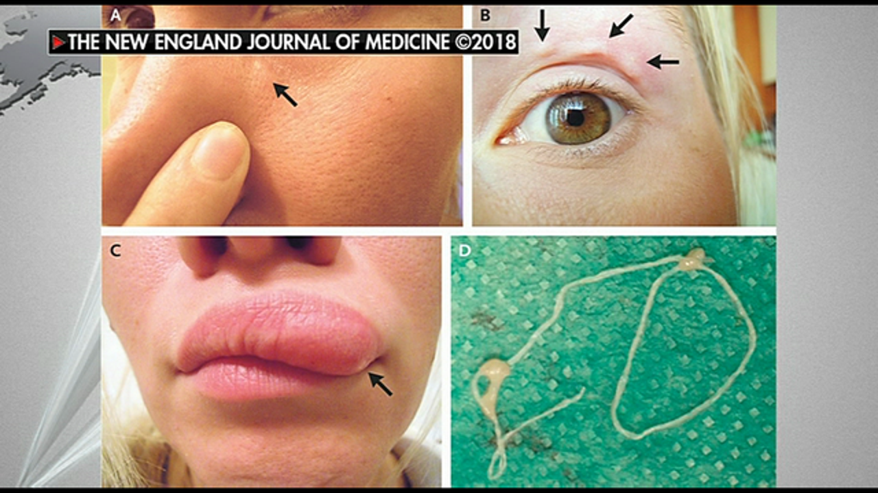 Parasite cause of moving bump on woman's face | FOX 26 Houston