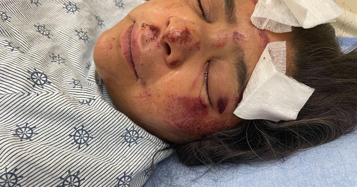 Woman injured in pedicab hit-and-run crash asking for driver to come ...