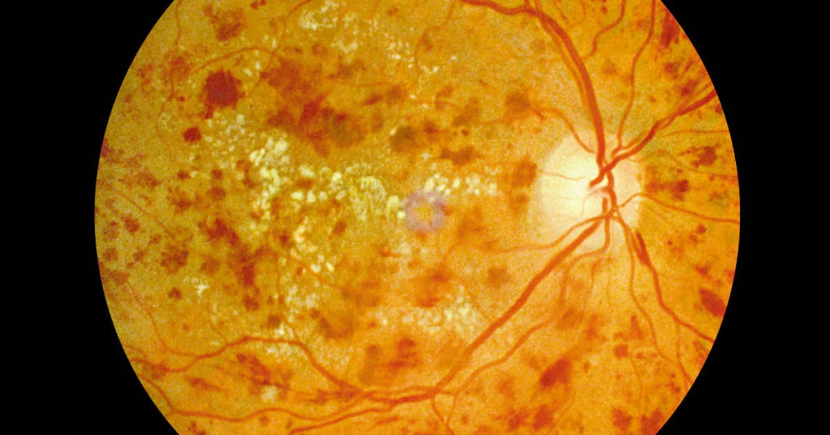 Preventing blindness caused by diabetes | FOX 26 Houston