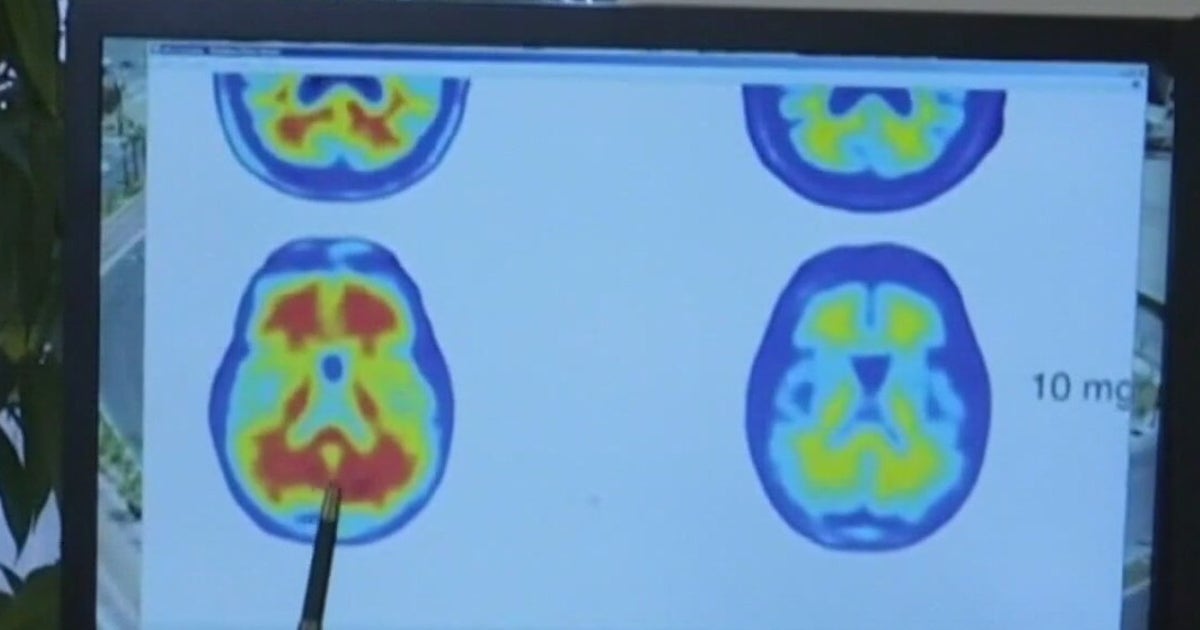 Alzheimer's disease could be reversed with investigational drug | FOX ...