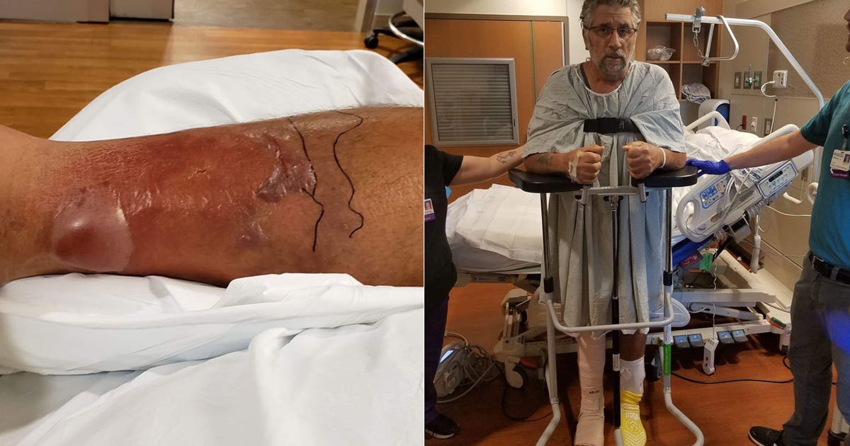 Florida man who thought he had a bad sunburn on leg nearly dies from ...