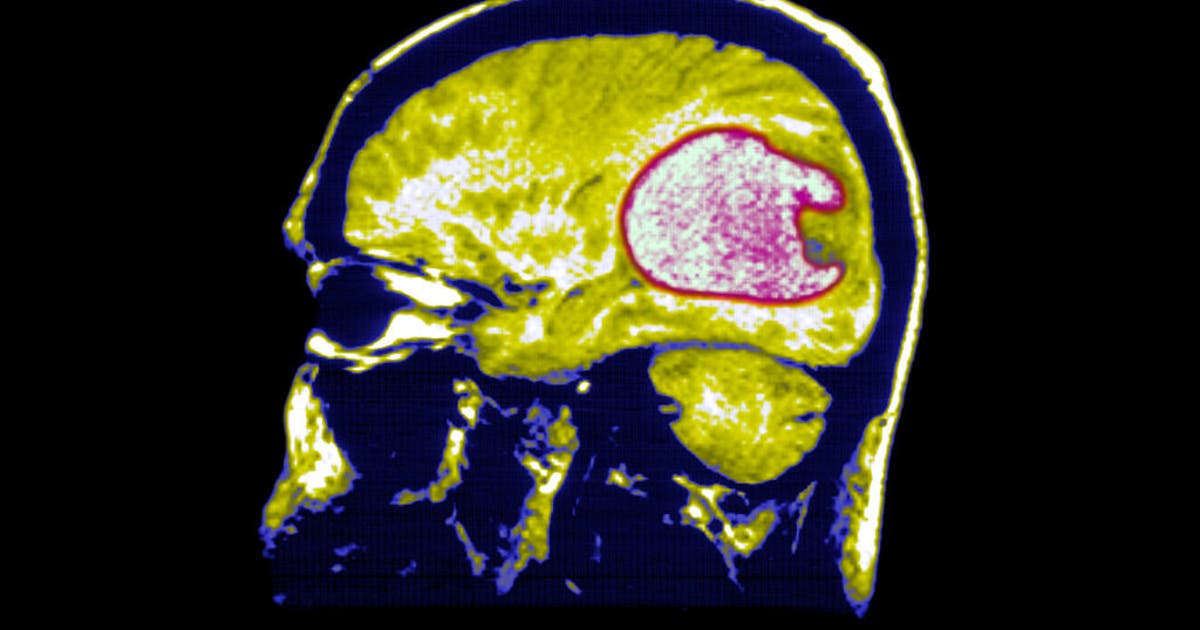 Scientists use new strategy to successfully shrink tumors in early ...