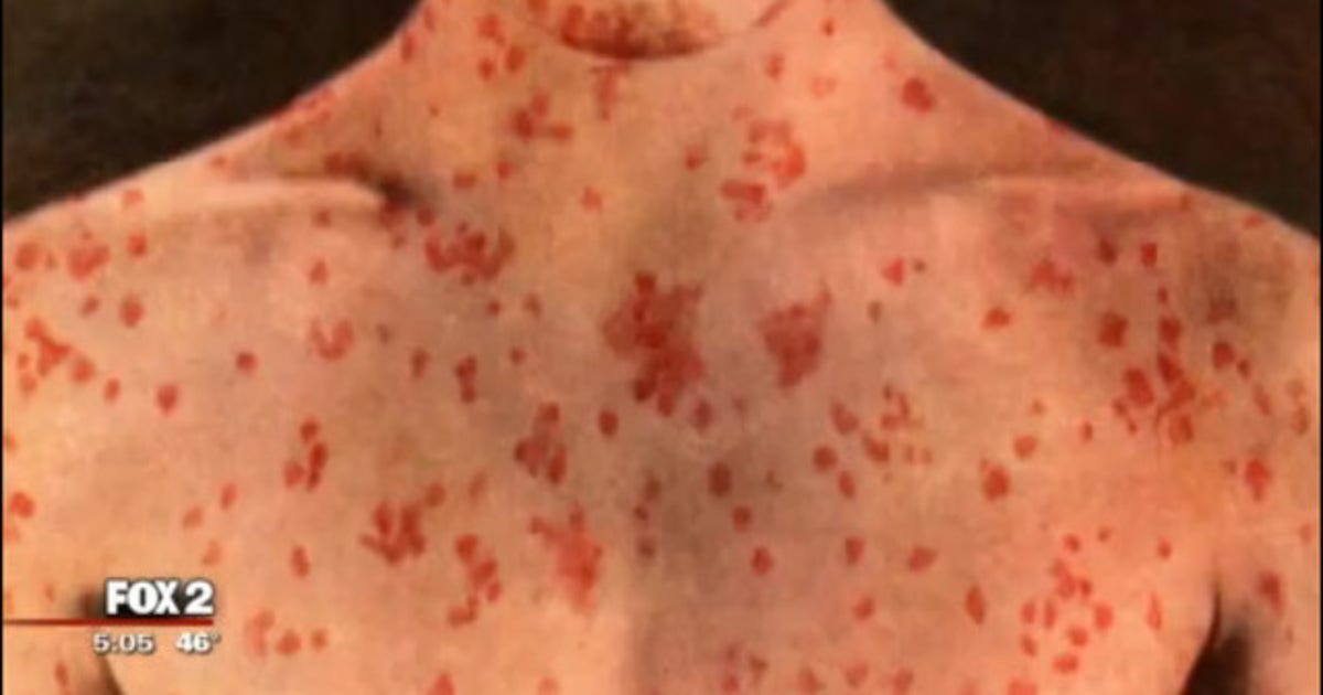 Confirmed measles cases reach 30 in southeast Michigan | FOX 2 Detroit