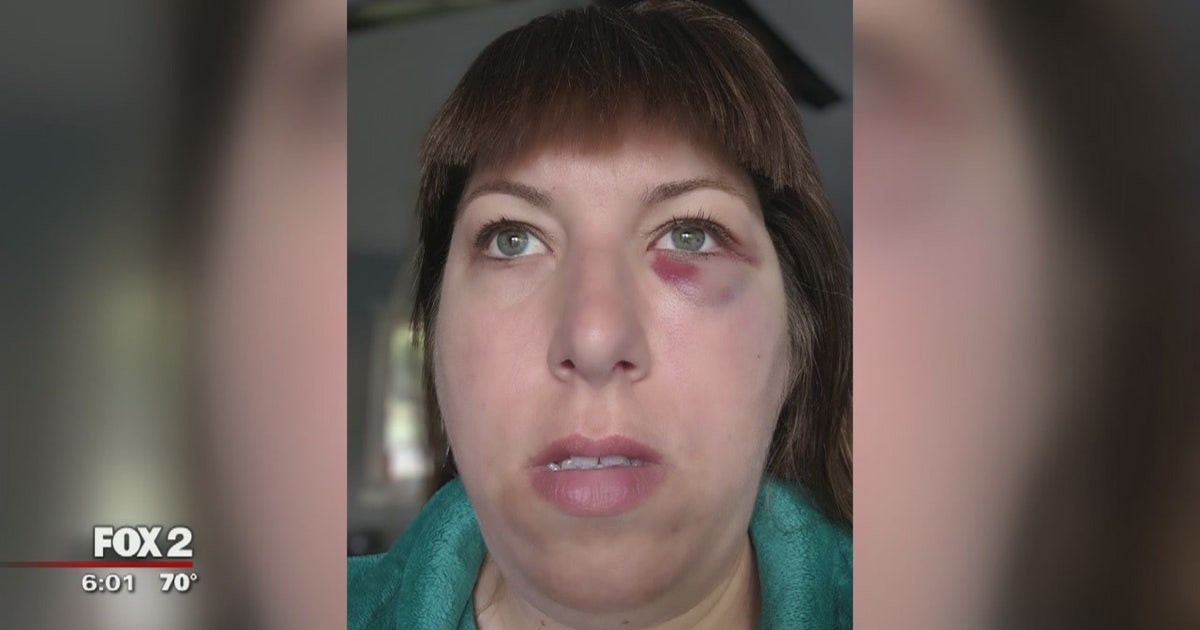 Woman sues hospital after getting punched unexpectedly in the face by a ...