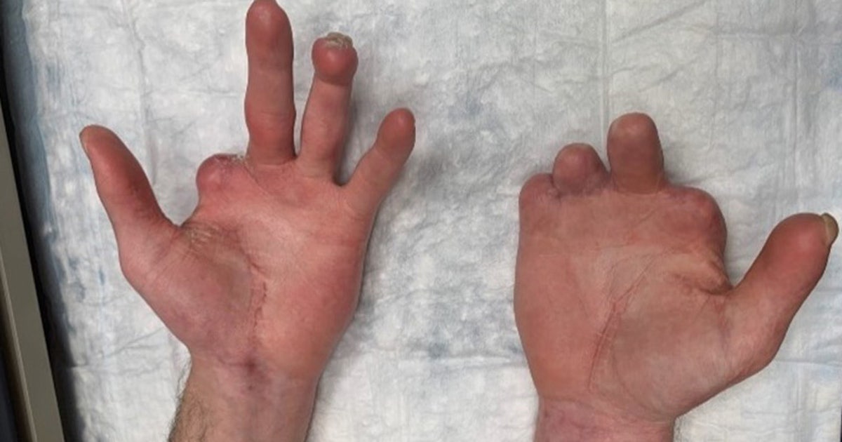 Kroger ordered to pay $75M+ to man who lost part of hands while working ...