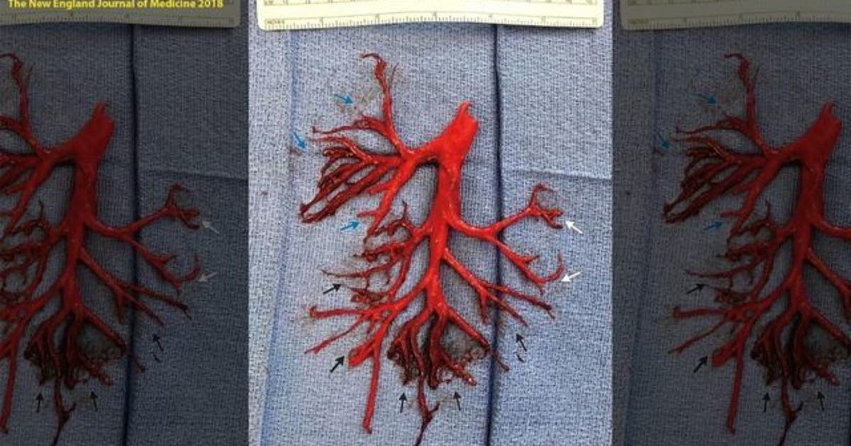Man coughs up blood clot shaped like lung's bronchial tree | FOX 32 Chicago
