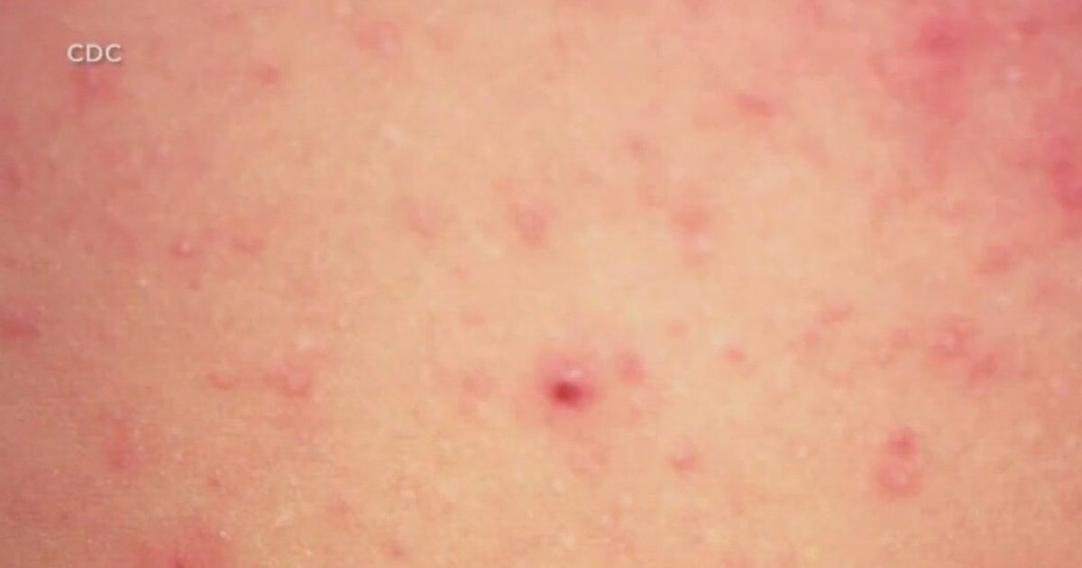 Indiana resident with measles visited 3 Chicago hospitals while ...