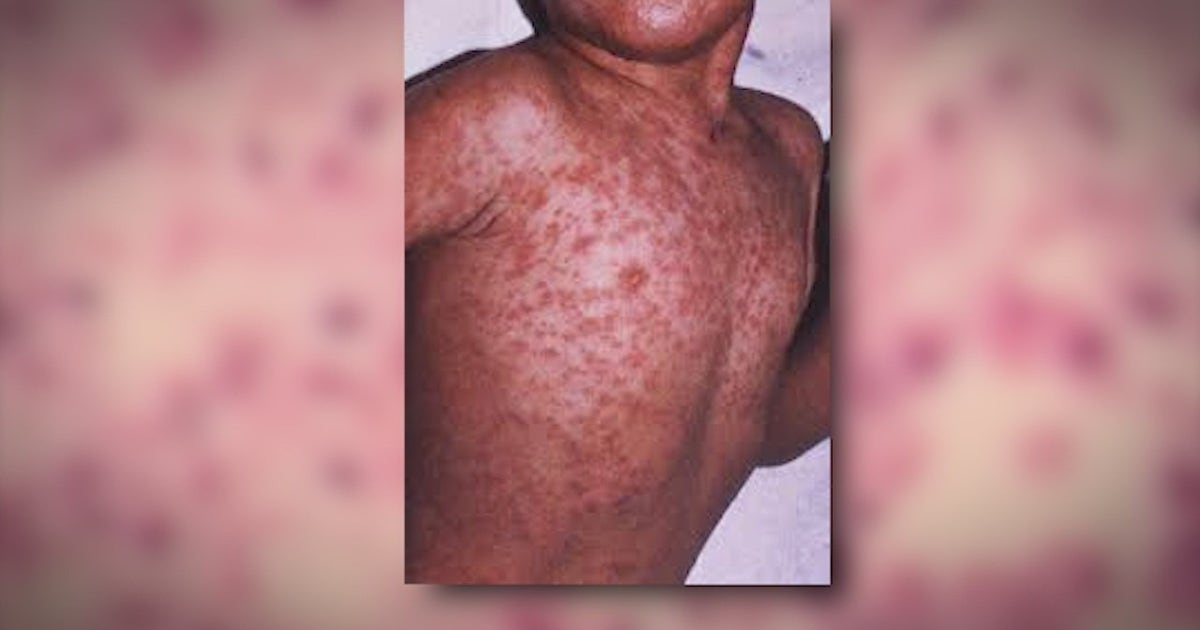 Measles in Chicago: Cases rise to 12 as health officials mobilize to ...