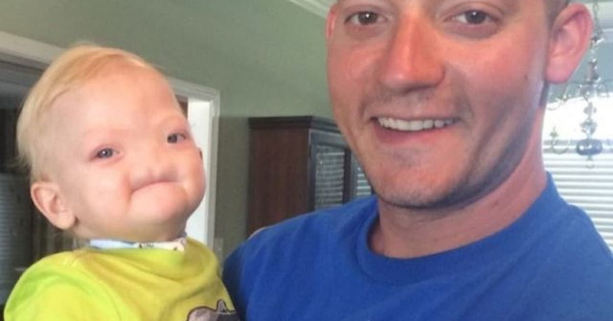 'Miracle baby' born without a nose dies at age 2 | FOX 35 Orlando