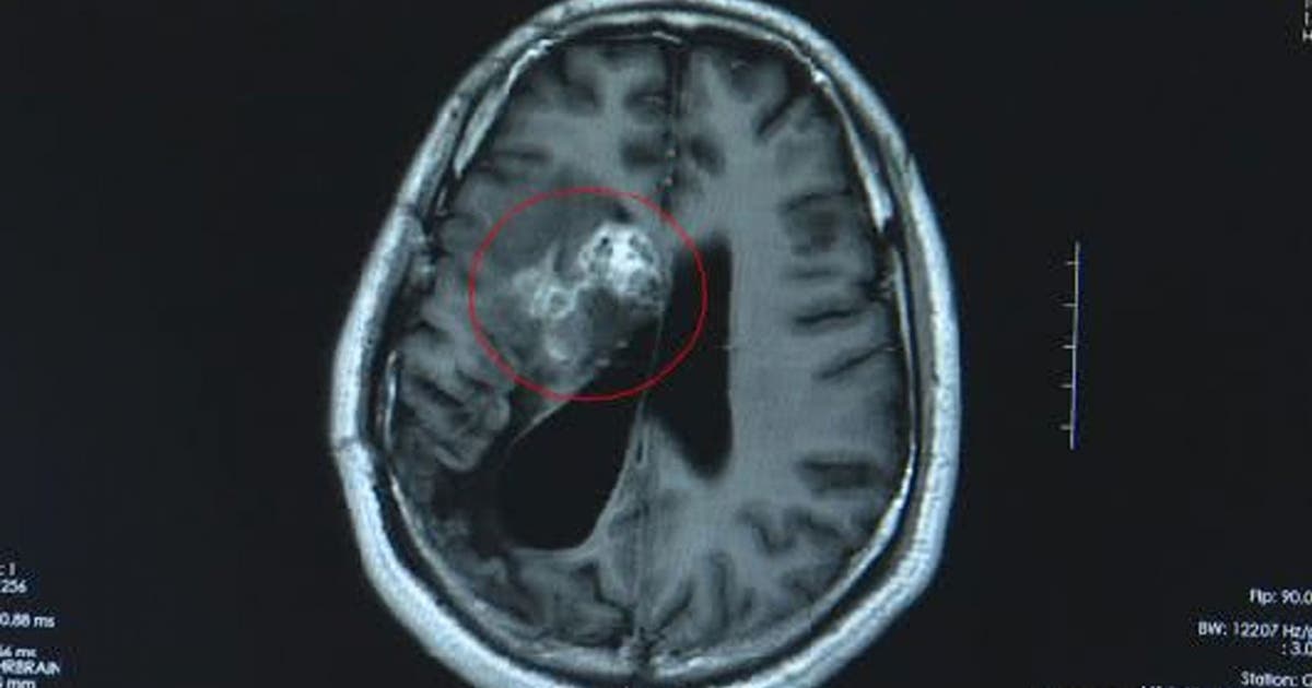 Man has 12-centimeter parasitic worm removed from brain after years of ...