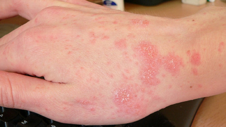 Reports of spike in scabies around Central Florida | FOX 35 Orlando