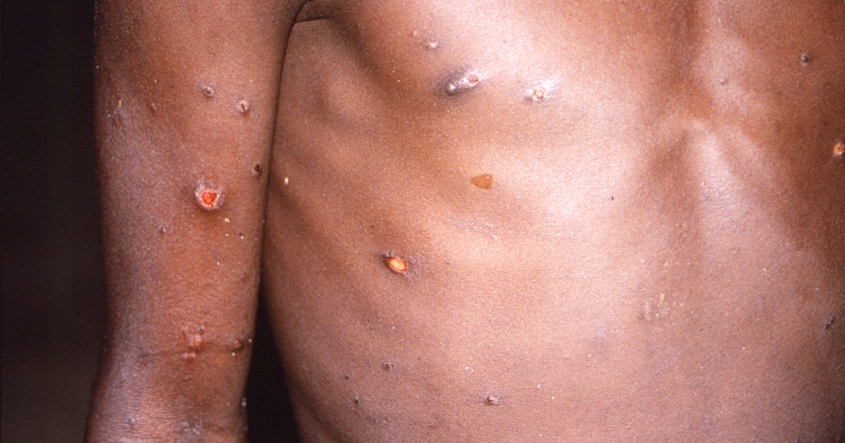 Monkeypox in Florida: Two more confirmed cases in Central Florida ...