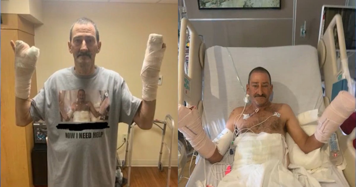 Florida man who lost most of his fingers in fireworks explosion opens ...