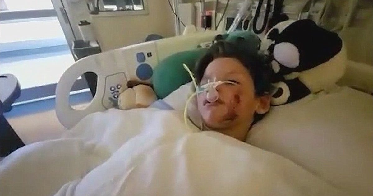Campfire accident leaves 9-year-old Fruitland Park boy with burns to 40 ...
