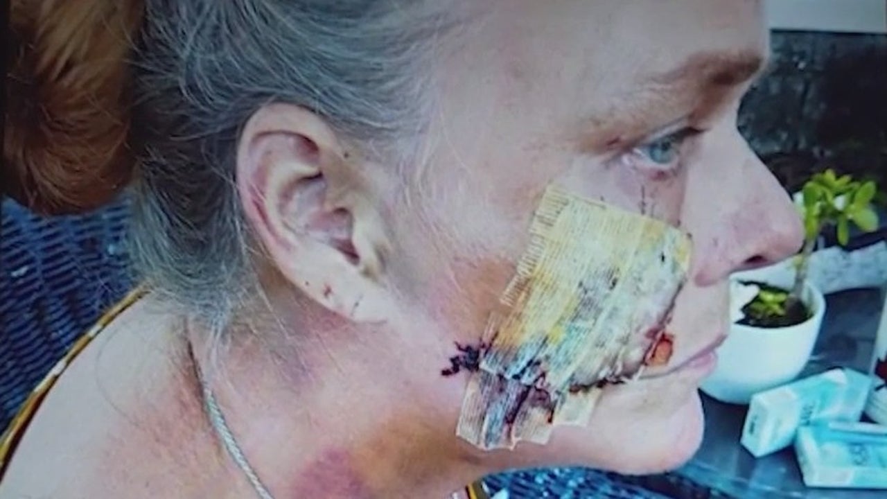 Caregiver recovering after dog mauling in Cocoa faces long road to ...