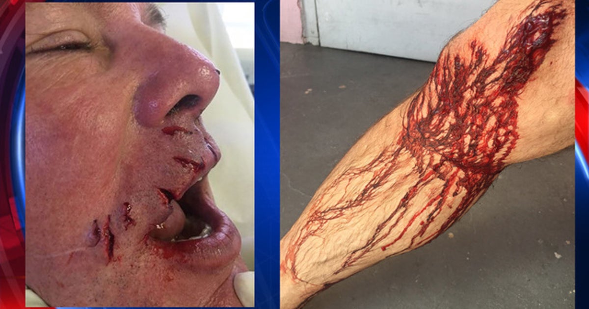 Waco dentist on vacation in Bahamas survives shark attack | FOX 4 ...