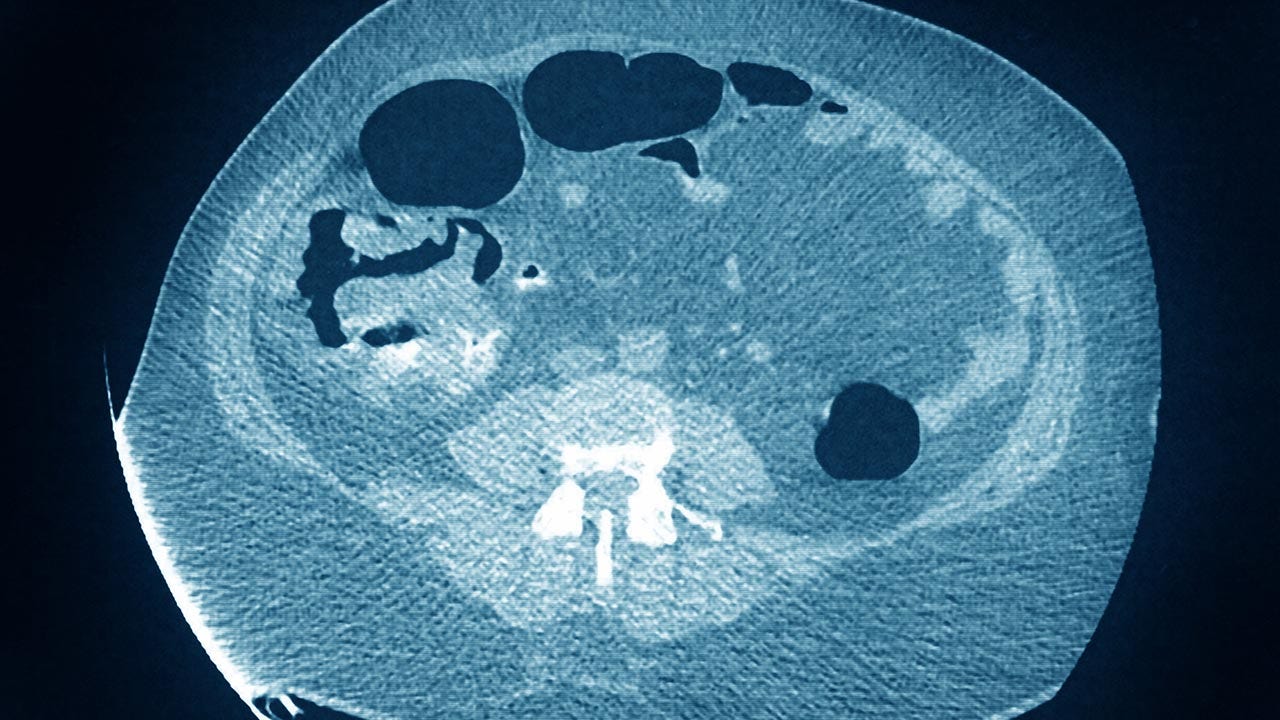New blood test helps Texas doctors detect colon cancer in patients ...