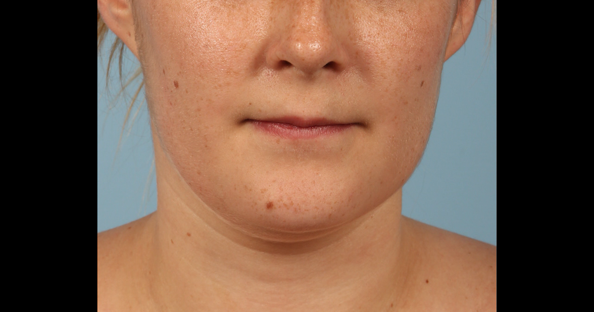 Double Chin Fix Drug | FOX 5 Atlanta
