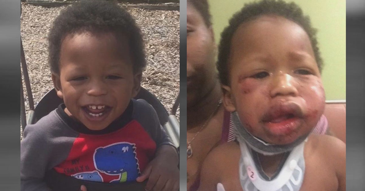 Baby hospitalized after beating at daycare | FOX 5 Atlanta