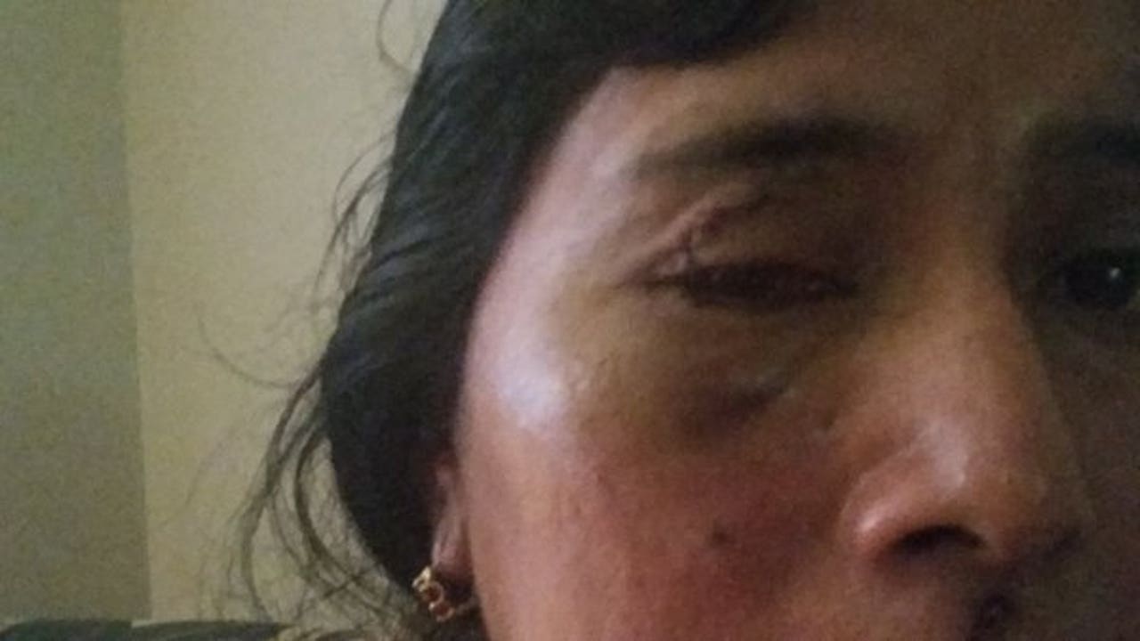 Woman stabbed in the eye by a burglar | FOX 5 Atlanta