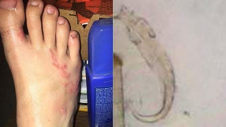 Teen contracts parasitic worm at beach | FOX 5 Atlanta