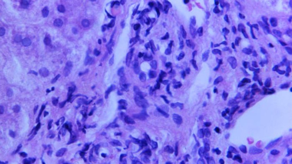 Spike in liver disease in children under investigation | FOX 5 Atlanta